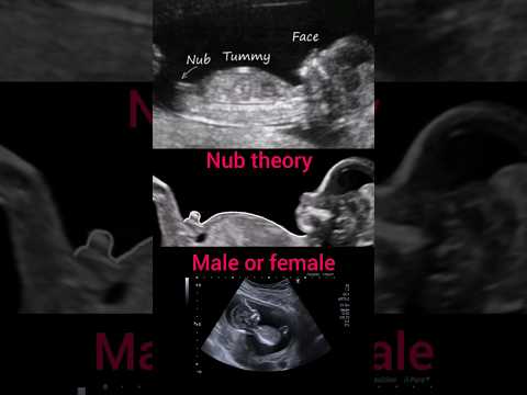 Nub theory||male or female||pregnancy #ultrasound#baby#shorts