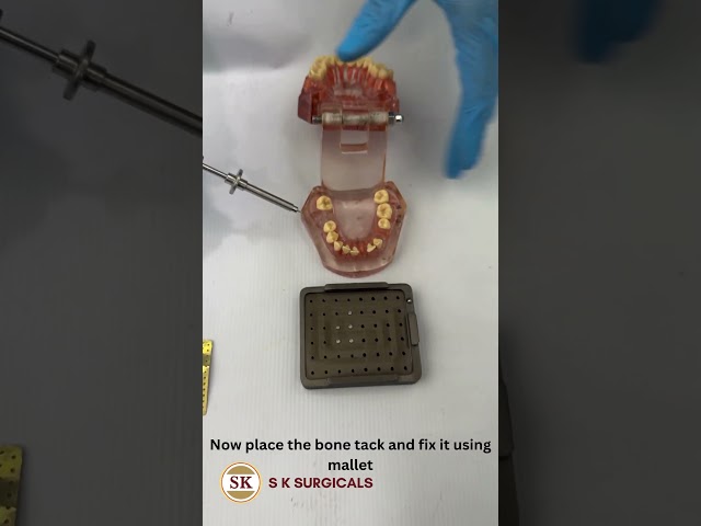 GBR Bone Tack - GBR Bone Tack Set Guided Bone Regeneration Tack ...