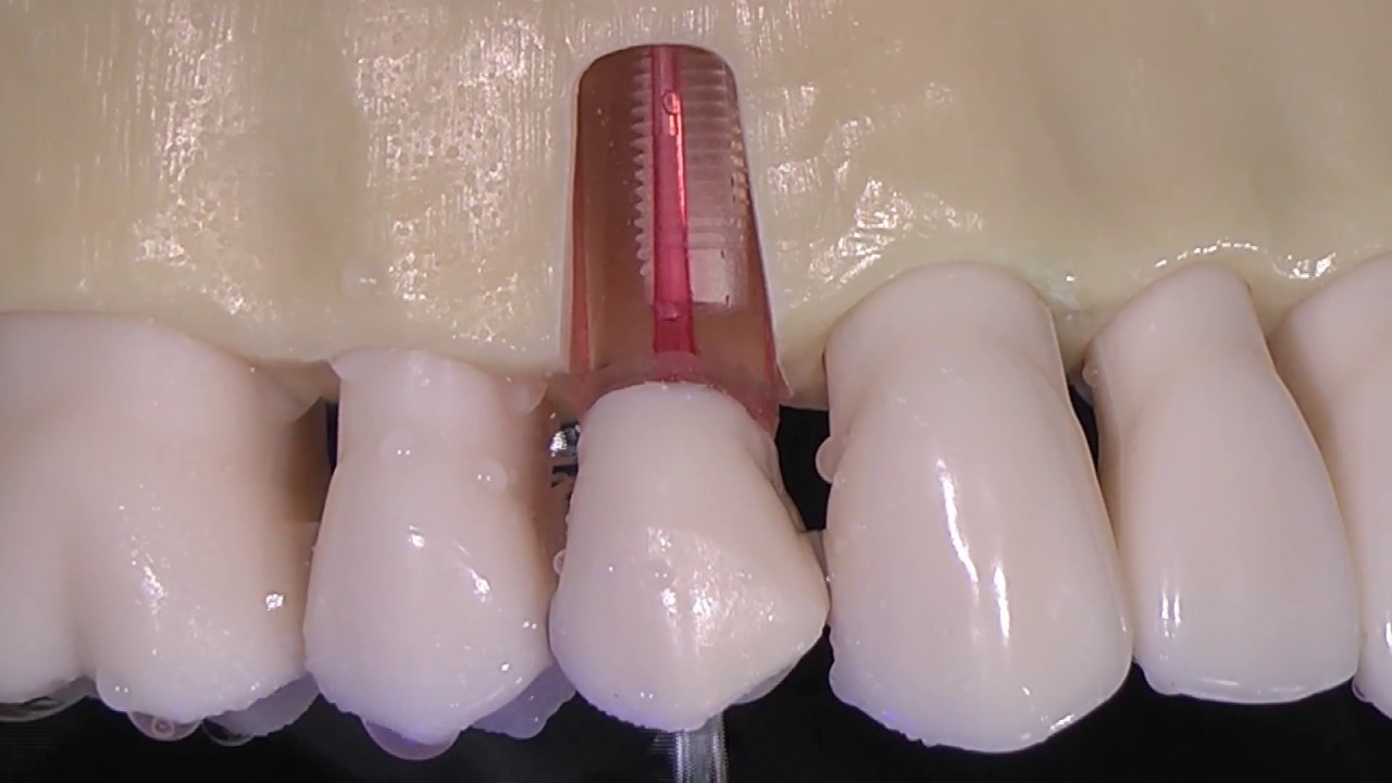 Insert Endosuccess retraitement Acteon