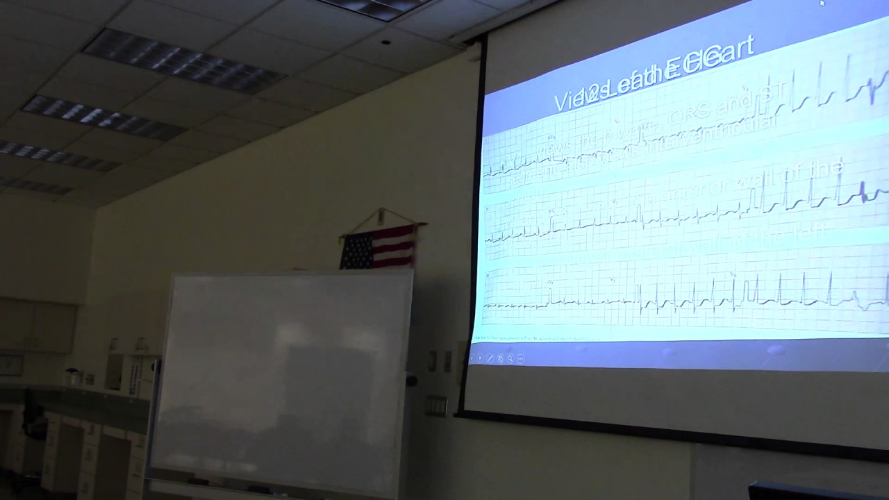 Heart Blocks & Pacemaker Rhythms Part 2