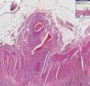 Histopathology Small intestine--Rheumatoid vasculitis