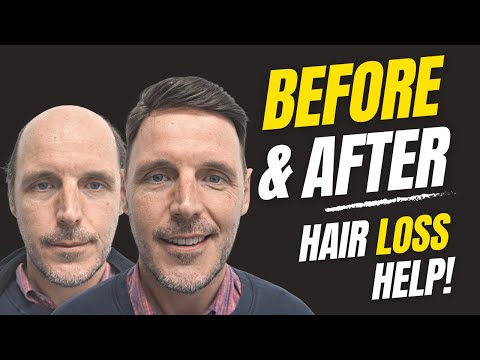 Michael (Mike) | 10 Years Younger In 10 Days | Channel 5 | Fitting | UK | Hair System