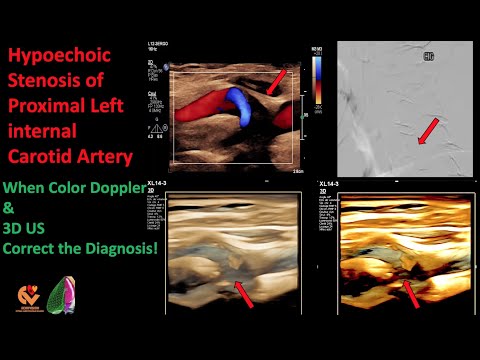 Hypoechoic Stenosis of Proximal Left internal Carotid Artery: Color Doppler & 3D US