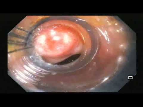 Neuro endocrine tumor in Duodenum removed with band assisted EMR.