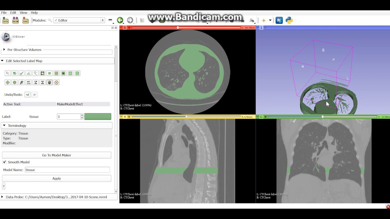 3D Slicer Segmentation + MATLAB Optimization