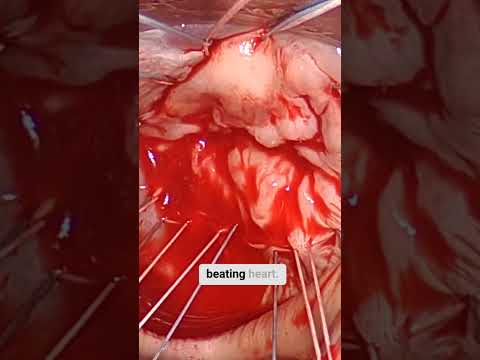 On-Pump Beating Heart Mitral Valve Repair Through Right Anterior Mini Thoracotomy #cardiac #CABG