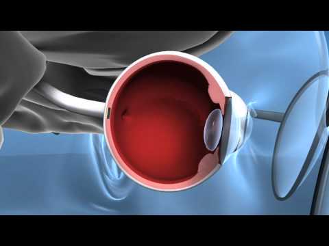 Bionic Eye Animation by MAGIPICS – The Eye Si(gh)t
