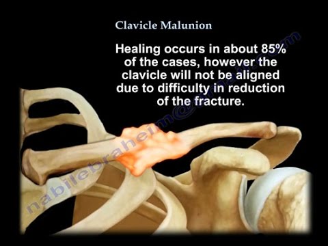 Malunion Of The Clavicle - Everything You Need To Know - Dr. Nabil Ebraheim