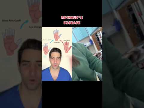 Raynauds Disease in the fingers or toes