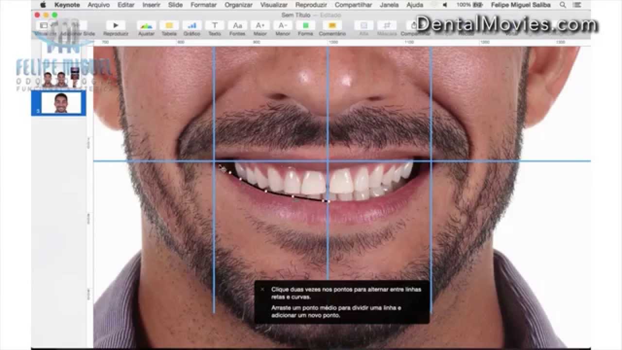 DSD - Digital Smile Design by Felipe Miguel