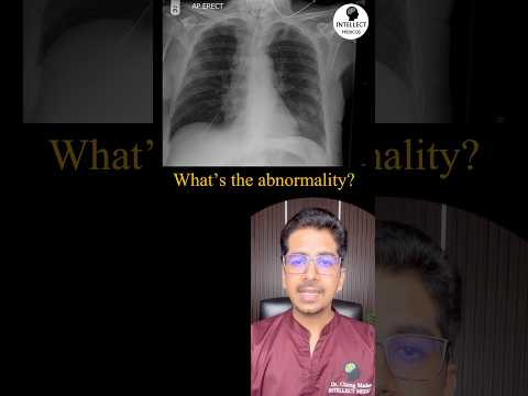 What’s the abnormality in Xray? #pulmonology #radiology #icu