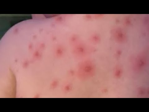 CHRIS & SARAH INGHAM SPREAD CHICKEN POX & SHINGLE VIRUS AROUND.......