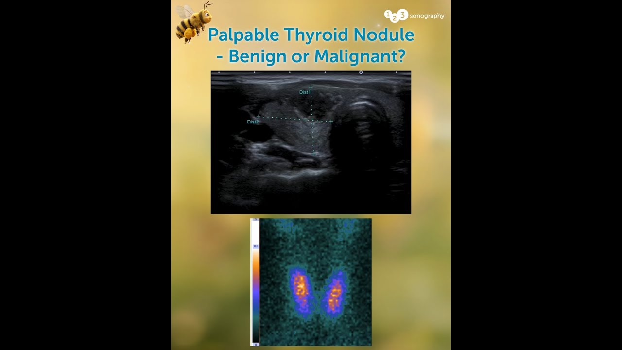 Case: Palpable Neck Lump 🔍🧐