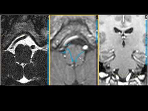 52The Real Origin of the Hypoglossal Nerve MRI Online