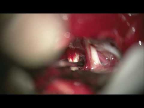 MVD for rt trigeminal neuralgia