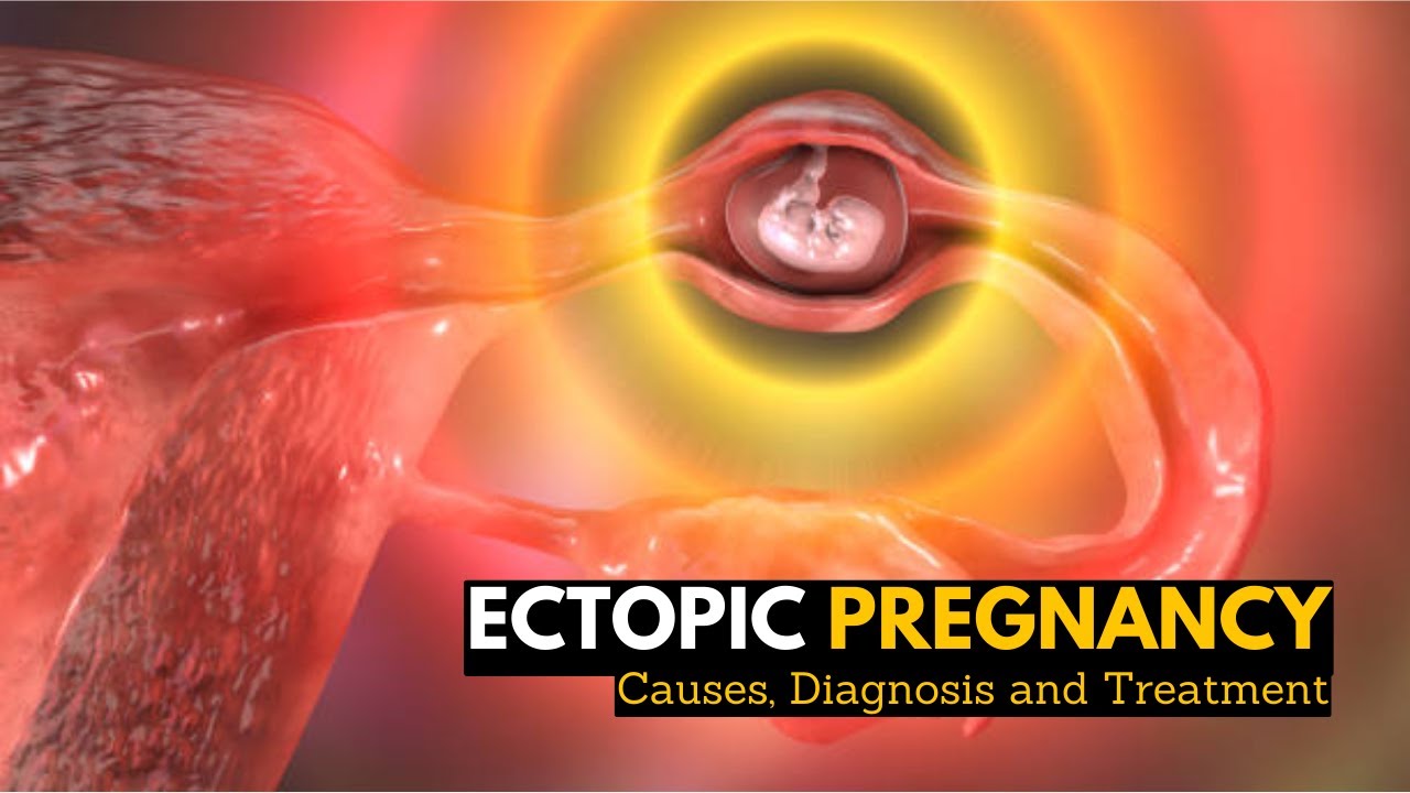 Ectopic Pregnancy, Causes, Signs and Symptoms, Diagnosis and Treatment.