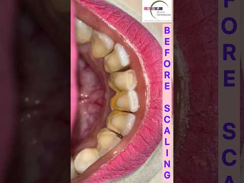 Teeth Cleaning by Doctor #scaling #teethcleaning #dentist