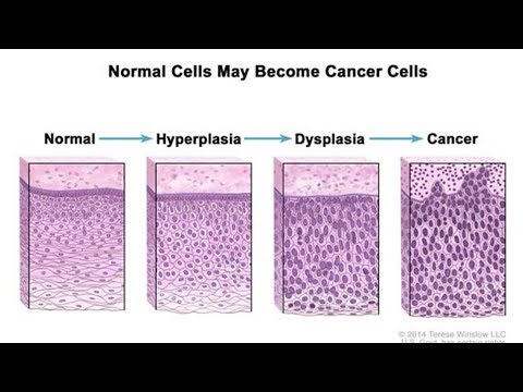 Is Severe Dysplasia a Form of Cancer? | Tita TV