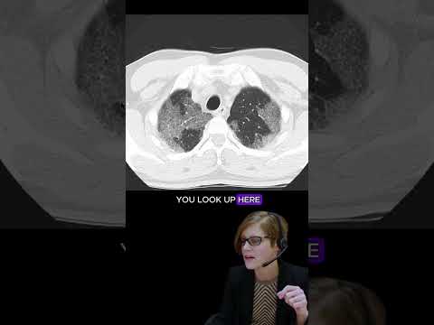 Pulmonary alveolar proteinosis with crazy paving pattern
