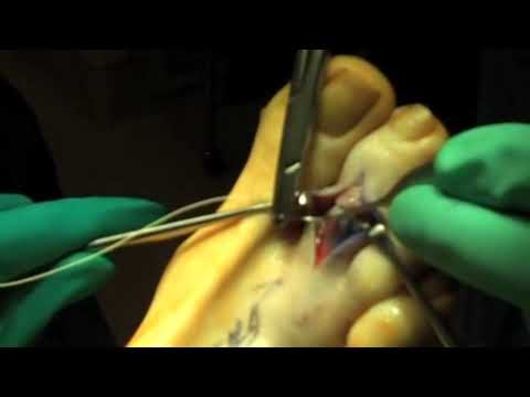 2nd PIPJ Arthrodesis with Smart Toe Implant from MMI