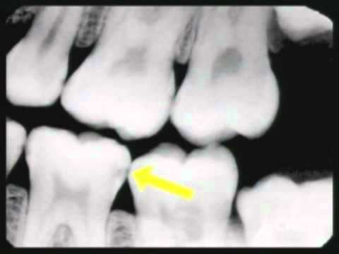 Digital X-Rays for Dental Diagnosis - California Dental Group