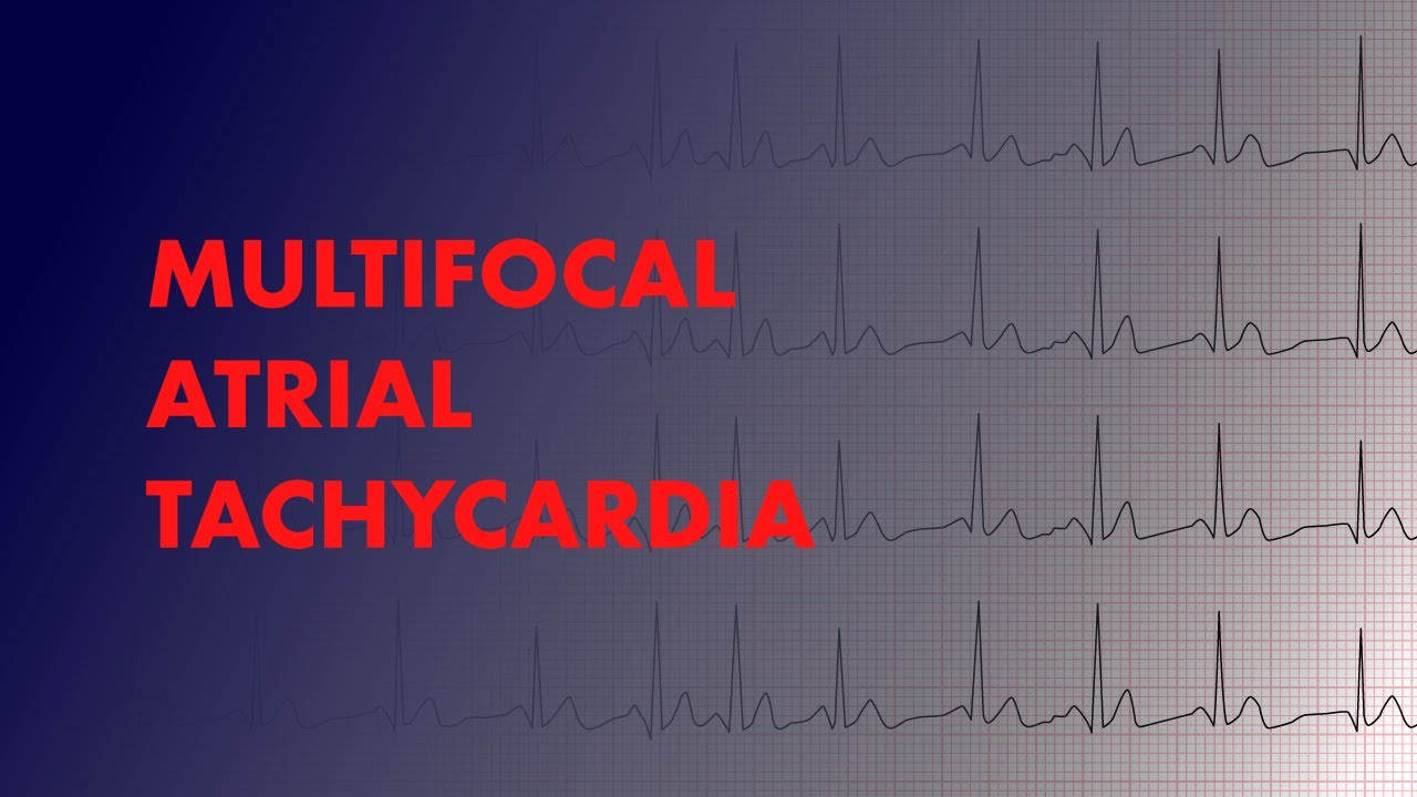 Multifocal Atrial Tachycardia -  EKG (ECG) Interpretation