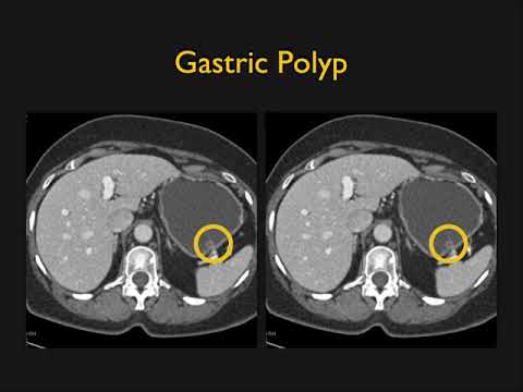 Missed Diagnosis in Body CT: Pearls and Pitfalls Part 2