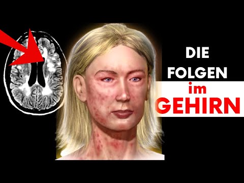 Multiple Sklerose: Arzt erklärt Entzündung, Symptome, Behandlung bei MS