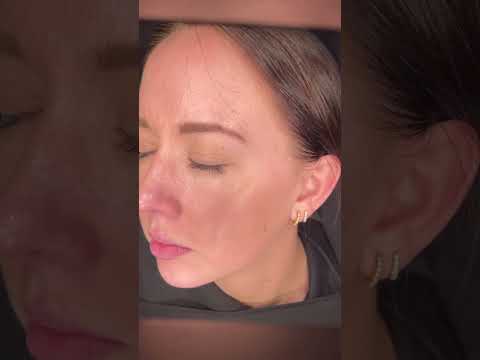 The power of the skin scope????!