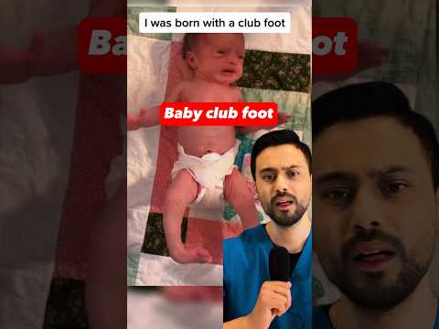 Baby Club Feet Treatment