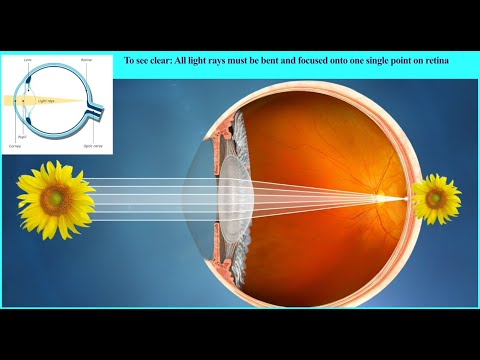 What is Myopia? What is Hyperopia? What is Astigmatism?
