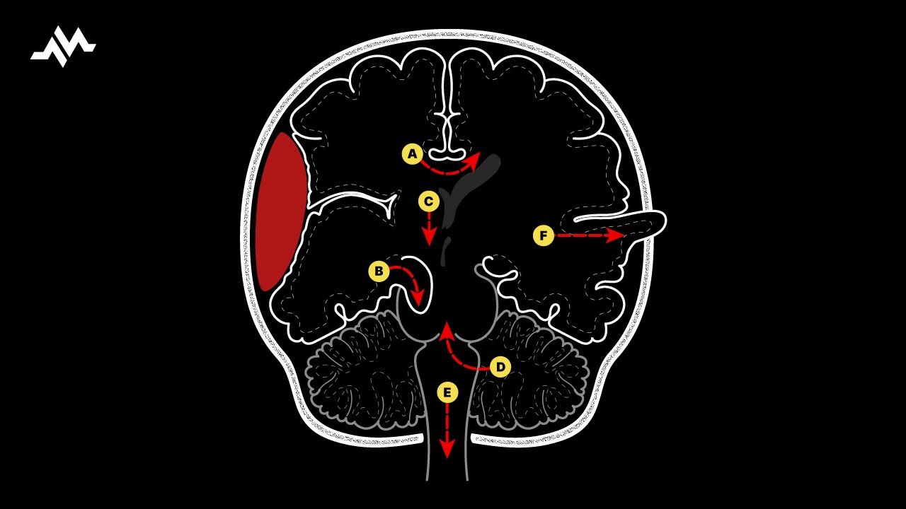 Brain Herniation Syndromes