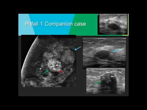 Breast Ultrasound Workshop Pitfalls Ultrasound Video Lecture