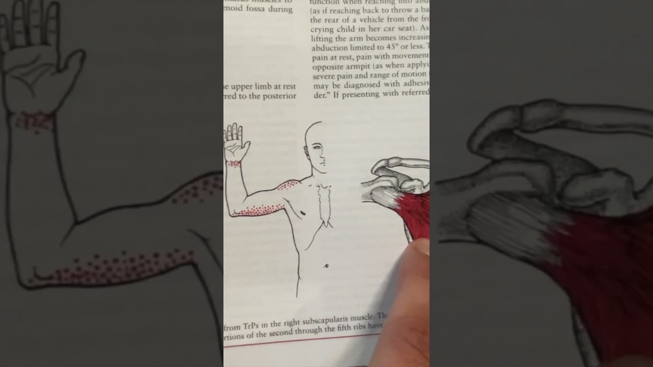 Trigger Point Pain From The Subscapularis
