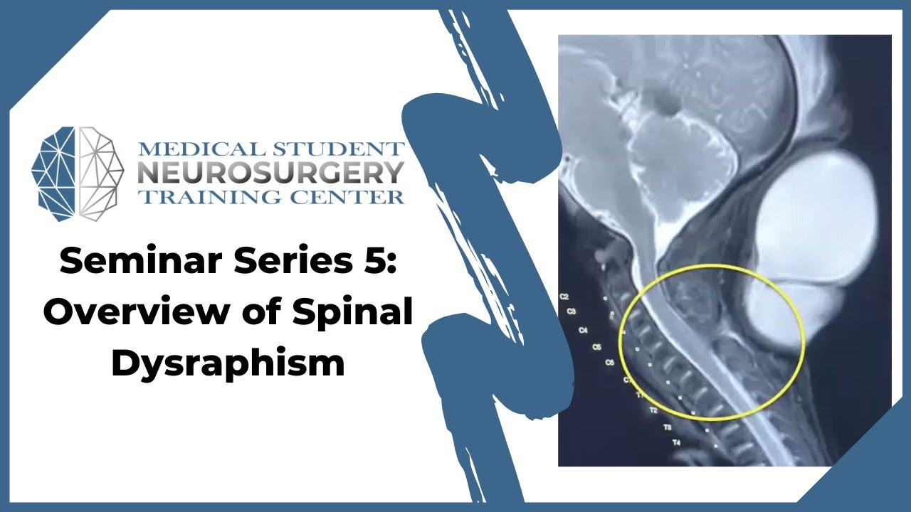 Understanding Spinal Dysraphism An Overview For Pediatric