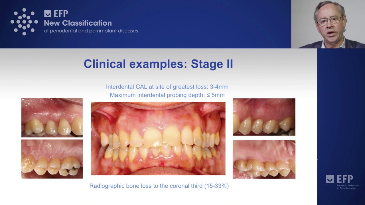 Assessing periodontitis: clinical examples & key points - tutorial by Mariano Sanz