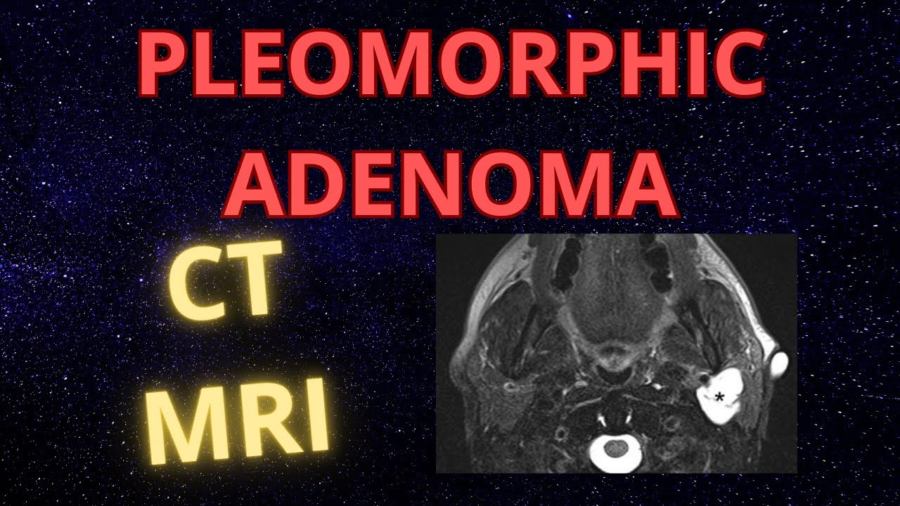 Pleomorphic Adenoma 🧠📸 CT & MRI Imaging Essentials