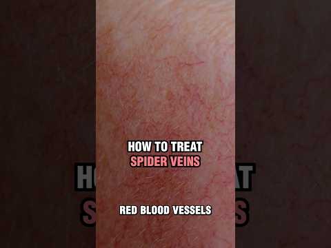How to treat spider veins and broken capillaries?