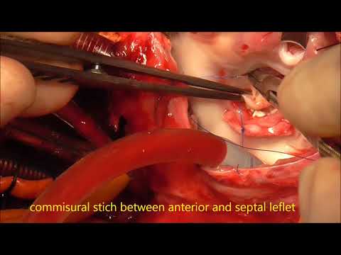 Infectective endocarditis-  post Tetrology repair (ICR)