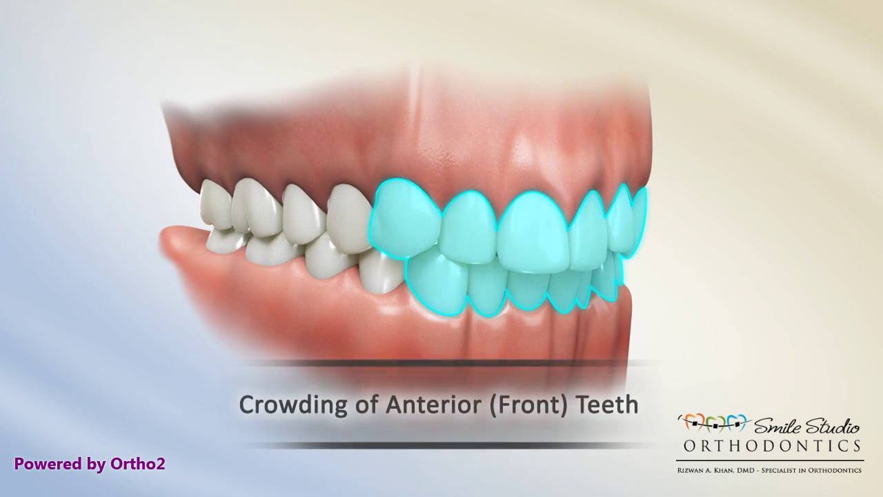 Class I Malocclusion