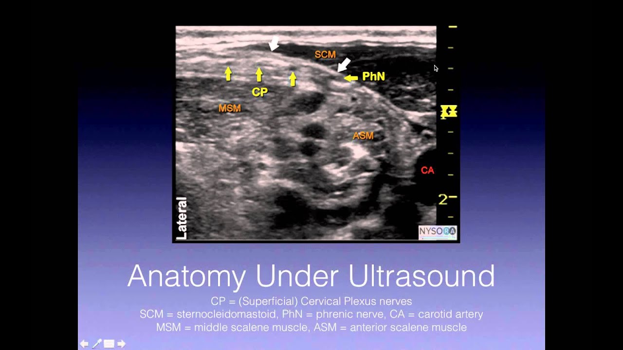 Tutorial: Superficial Cervical Plexus Block