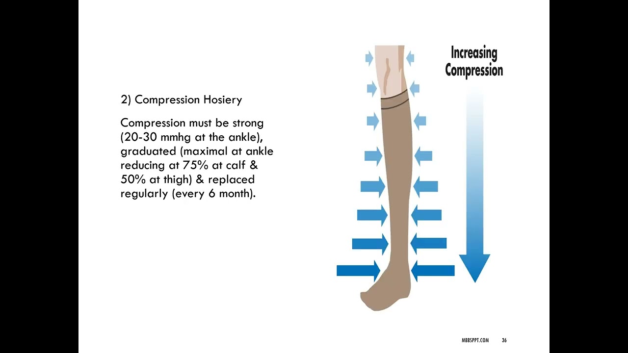 Varicose Vein PPT (Slide Presentation)