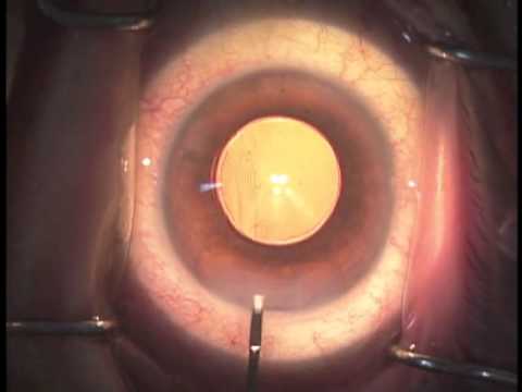 Intraocular lens position, capsulotomy size/shape affect centration, visual outcomes