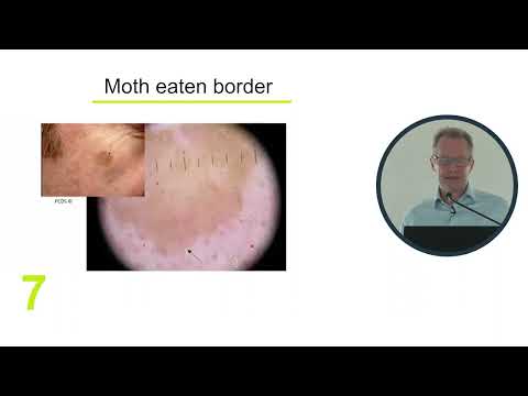 GatewayC Live: Greater Manchester – 12 Tips to Identify Seborrhoeic Keratosis