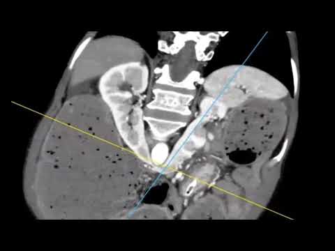horseshoe kidney