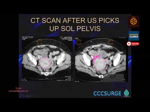 CCC Basic -Acute Appendicitis & Appendicectomy - Sanjay De Bakshi - 30.07.20