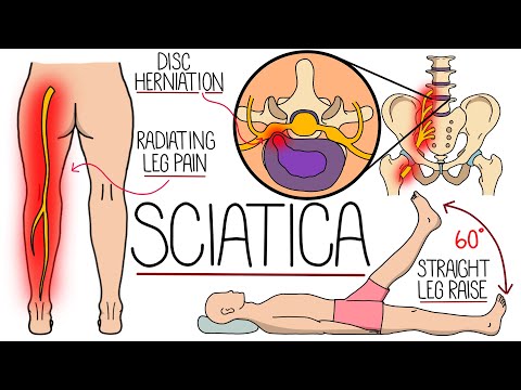 Sciatica Explained (Including Red Flag Symptoms)