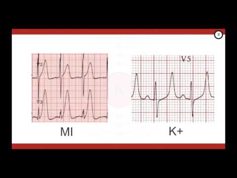 Emergency Management of Hyperkalemia (Part 1)