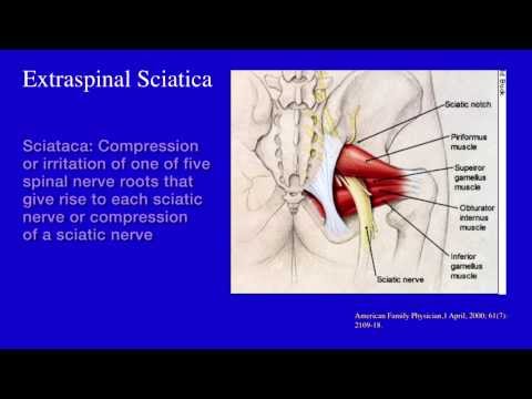 UCSF Radiology: Understanding Sciatica