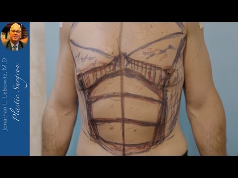 All Or Nothing VaserLipo & J-Plasma Skin Tightening Gynecomastia Surgery By Dr. Lebowitz